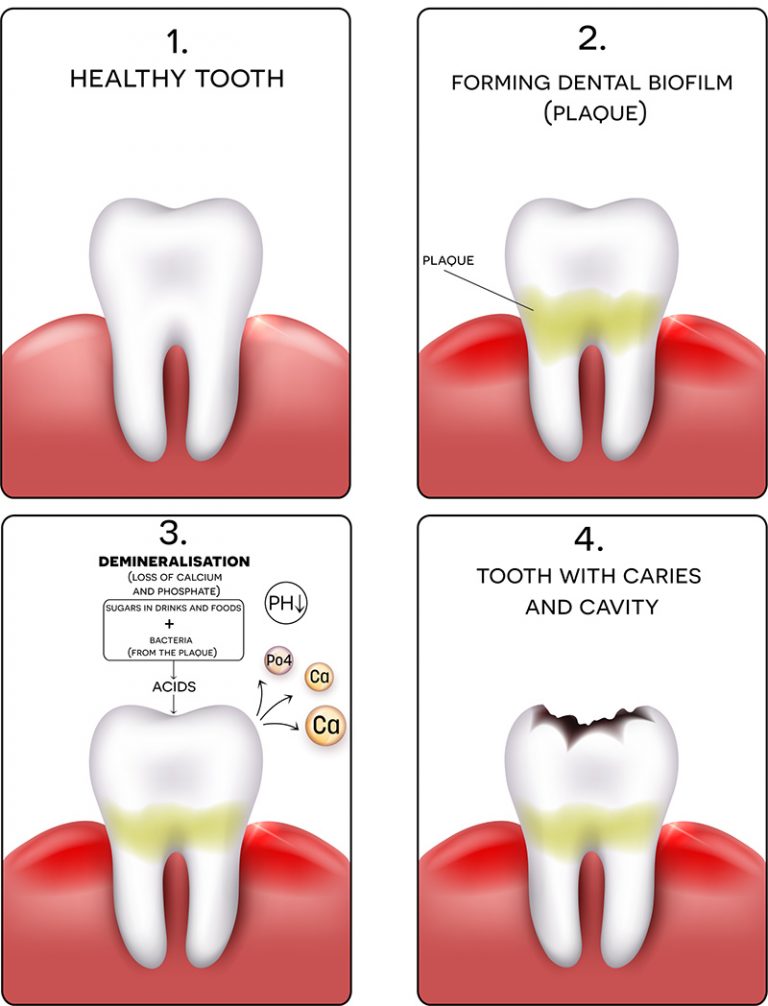 Cavities Symptoms Causes And Treatment Willow Pass Dental Care Cavities Symptoms Causes And Treatment Willow Pass Dental Care