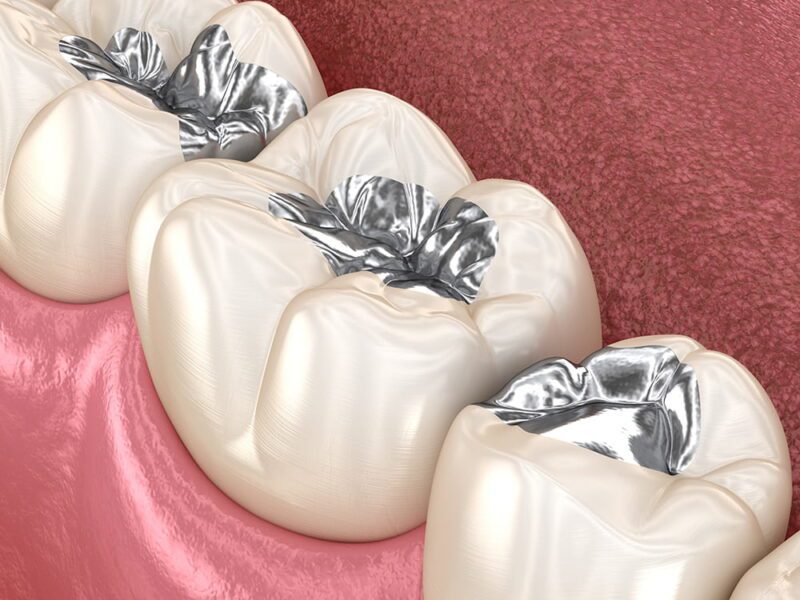 How Does A Cavity Filling Work? - Willow Pass Dental Care