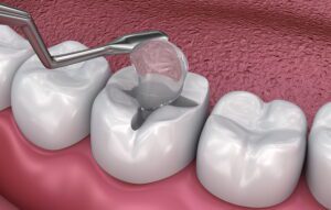 How Does A Cavity Filling Work? - Willow Pass Dental Care